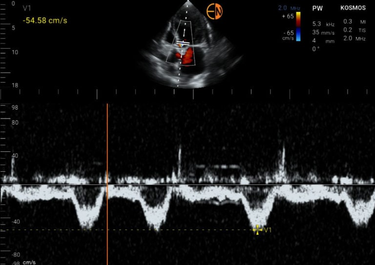 Diagnosing Aortic Stenosis With Ultrasound Ai Echonous